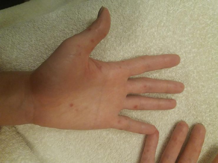 Lekarz dla dzieci: "BOSTONKA", czyli choroba dłoni, stóp i jamy ustnej