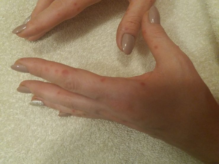 Lekarz dla dzieci: "BOSTONKA", czyli choroba dłoni, stóp i jamy ustnej