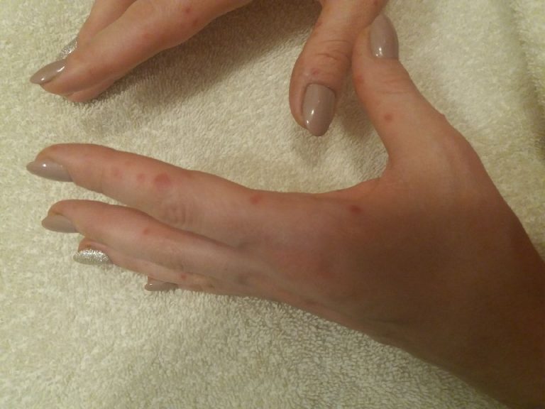 Lekarz dla dzieci: "BOSTONKA", czyli choroba dłoni, stóp i jamy ustnej