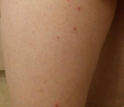 Lekarz dla dzieci: "BOSTONKA", czyli choroba dłoni, stóp i jamy ustnej